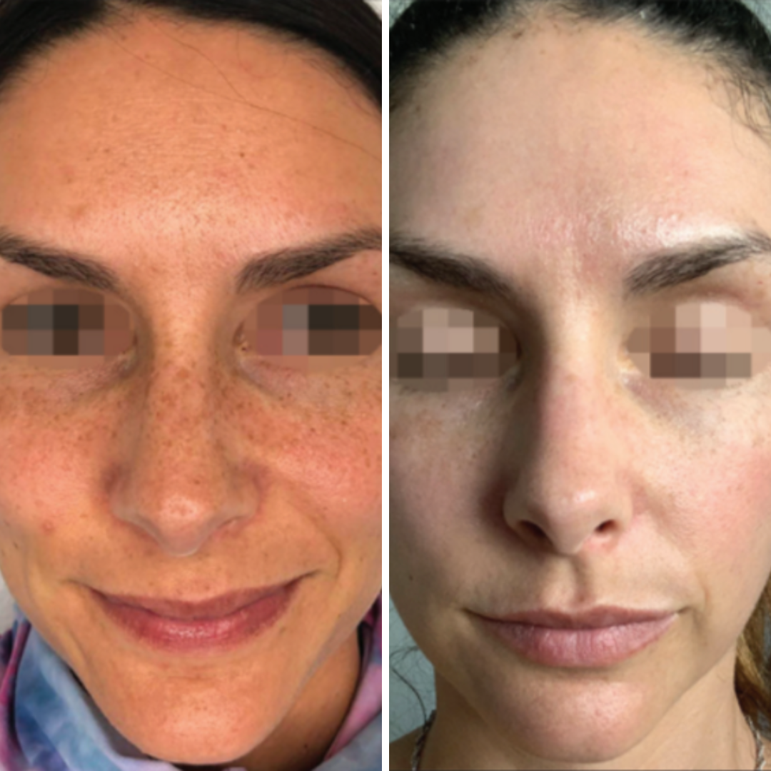 ALMA HYBRID - Laser Country Dermatología