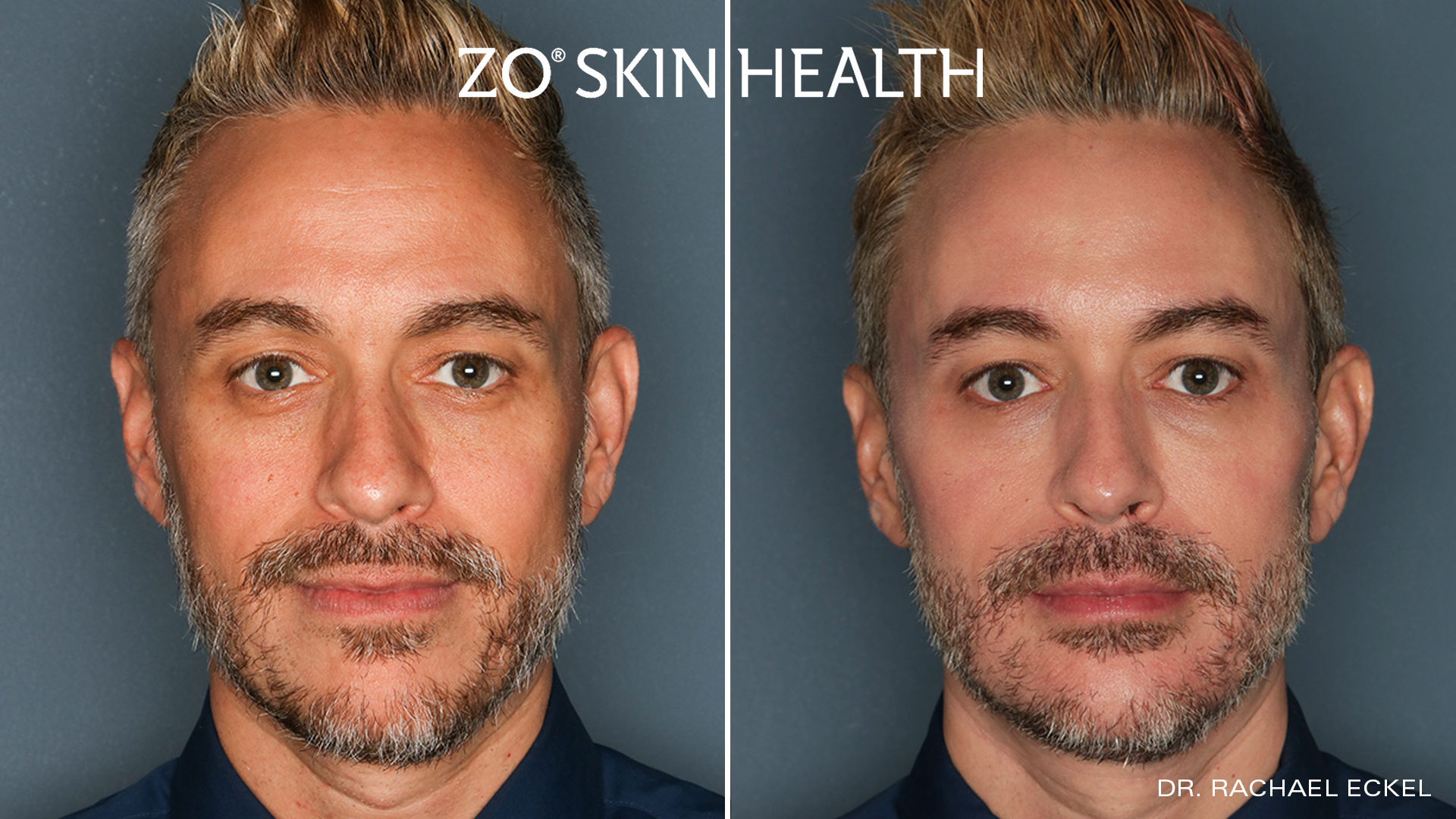 ZO - Laser Country Dermatología